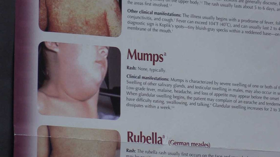 Heber Family: Immunized 11-Year-Old Tests Positive For Mumps