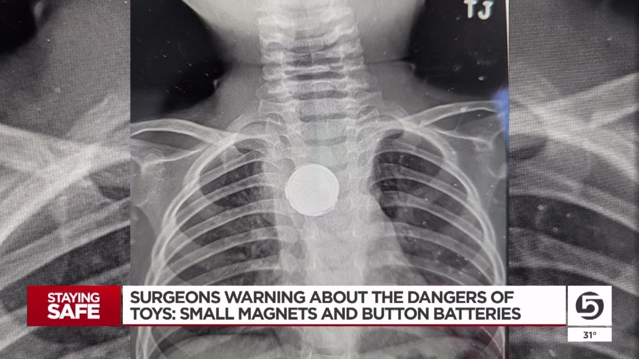 Video: Surgeons warning about the dangers of toys with small magnets ...